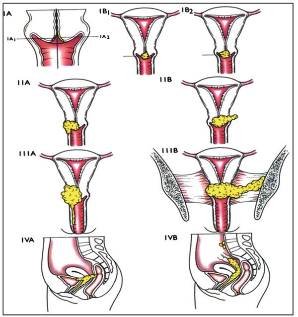 Cervix Cancer Staging