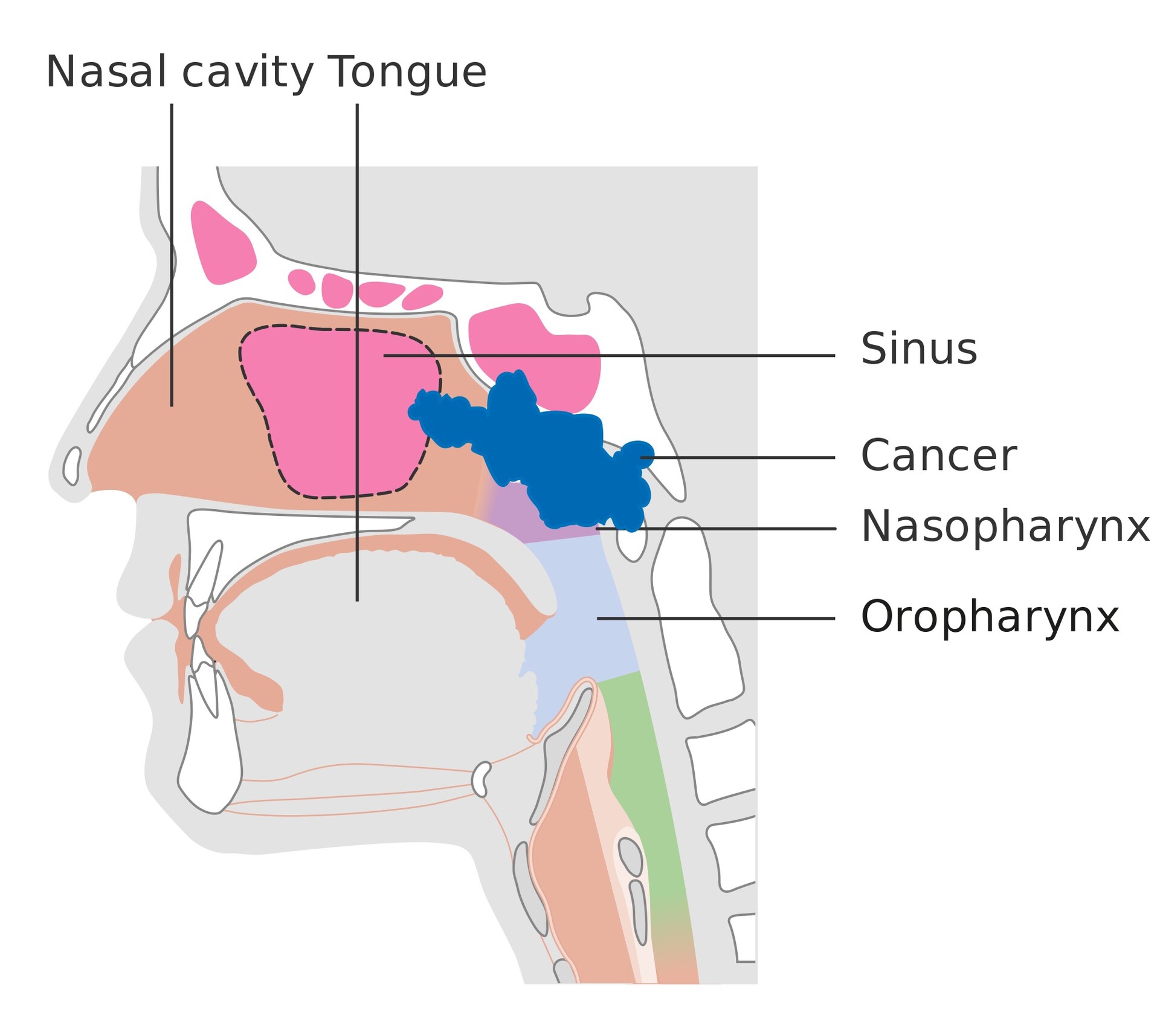 Nasopharyngeal Cancer Symptoms Stages Treatment Early Signs Of Tonsil