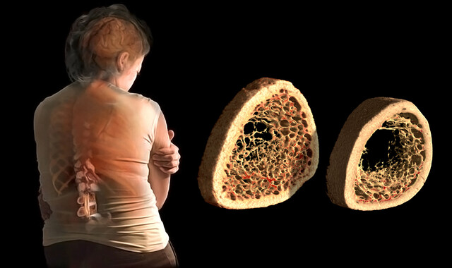 The Bone-Ified Truth: Why Every Woman Should Care About Bone Health