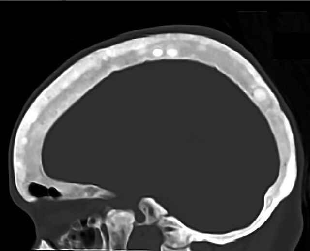 Renal Osteodystrophy Spine