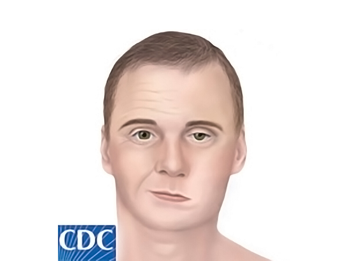 Bell's Palsy Fun Facts at Victoria Melrose blog