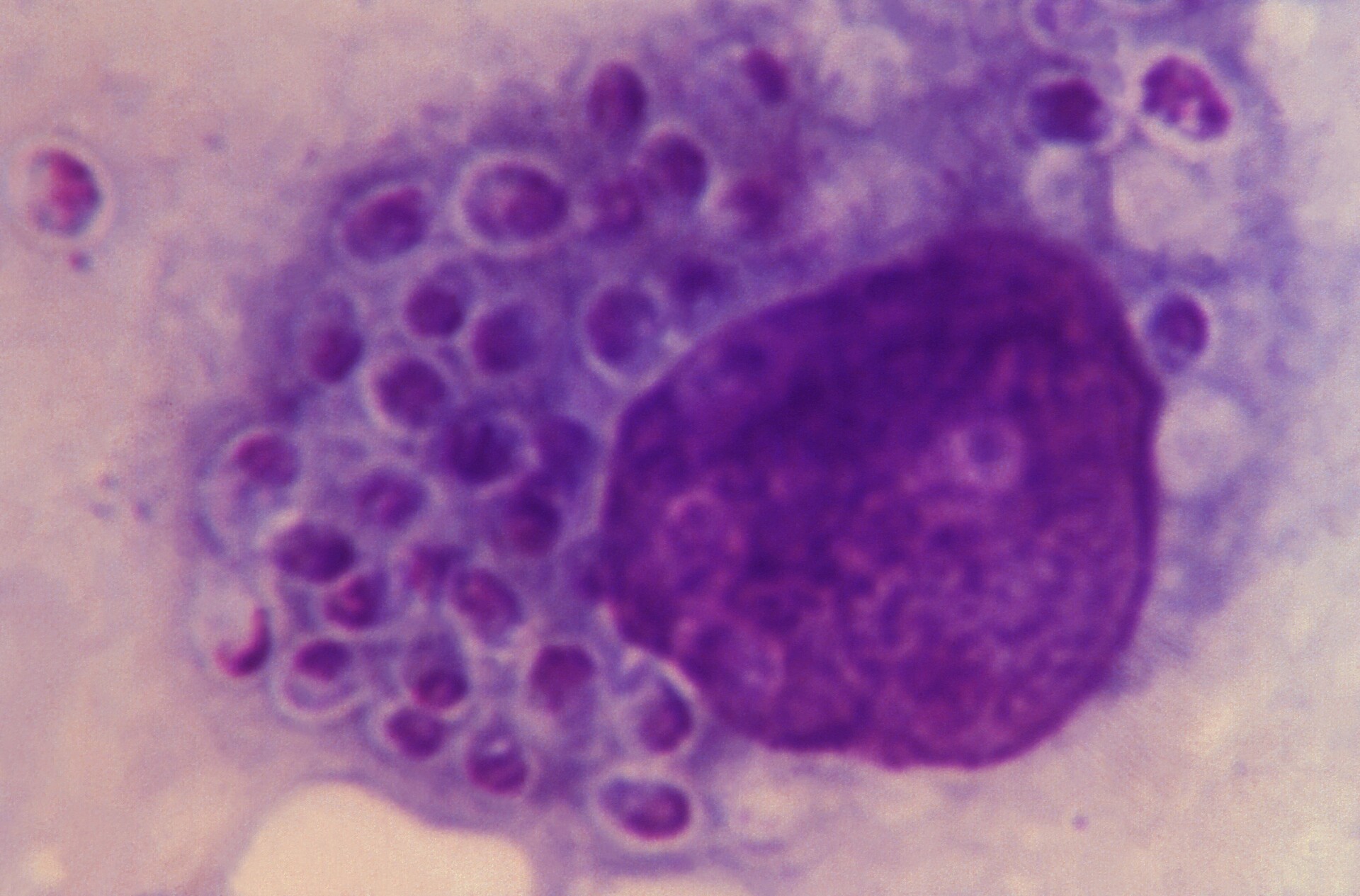 Preventing Deaths From Histoplasmosis StoryMD Preventing Deaths From Histoplasmosis StoryMD