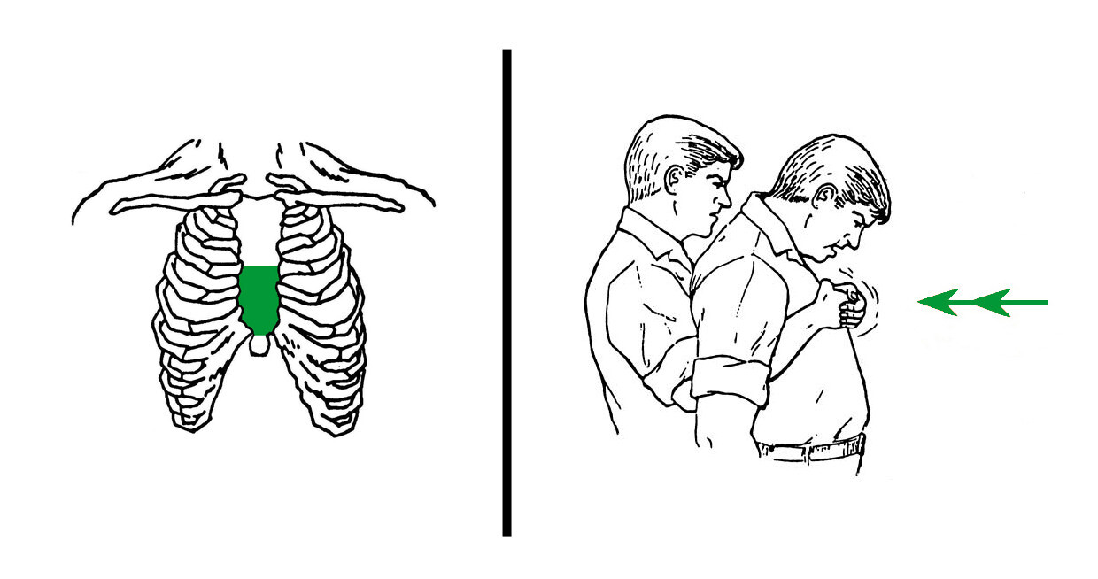 Heimlich Maneuver Young Man Saving Life Of Woman Performing 41 OFF Heimlich Maneuver Young Man Saving Life Of Woman Performing 41 OFF