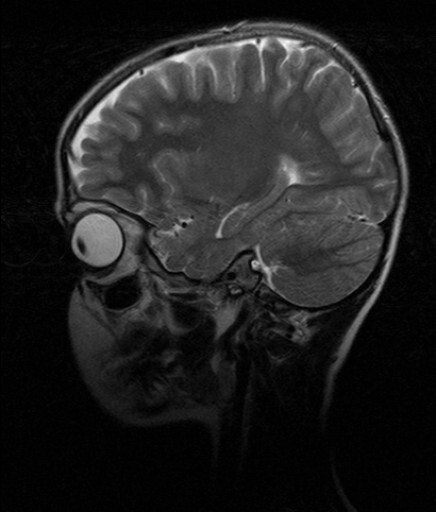 Ependymom Ependymal Tumors | Radiology Key