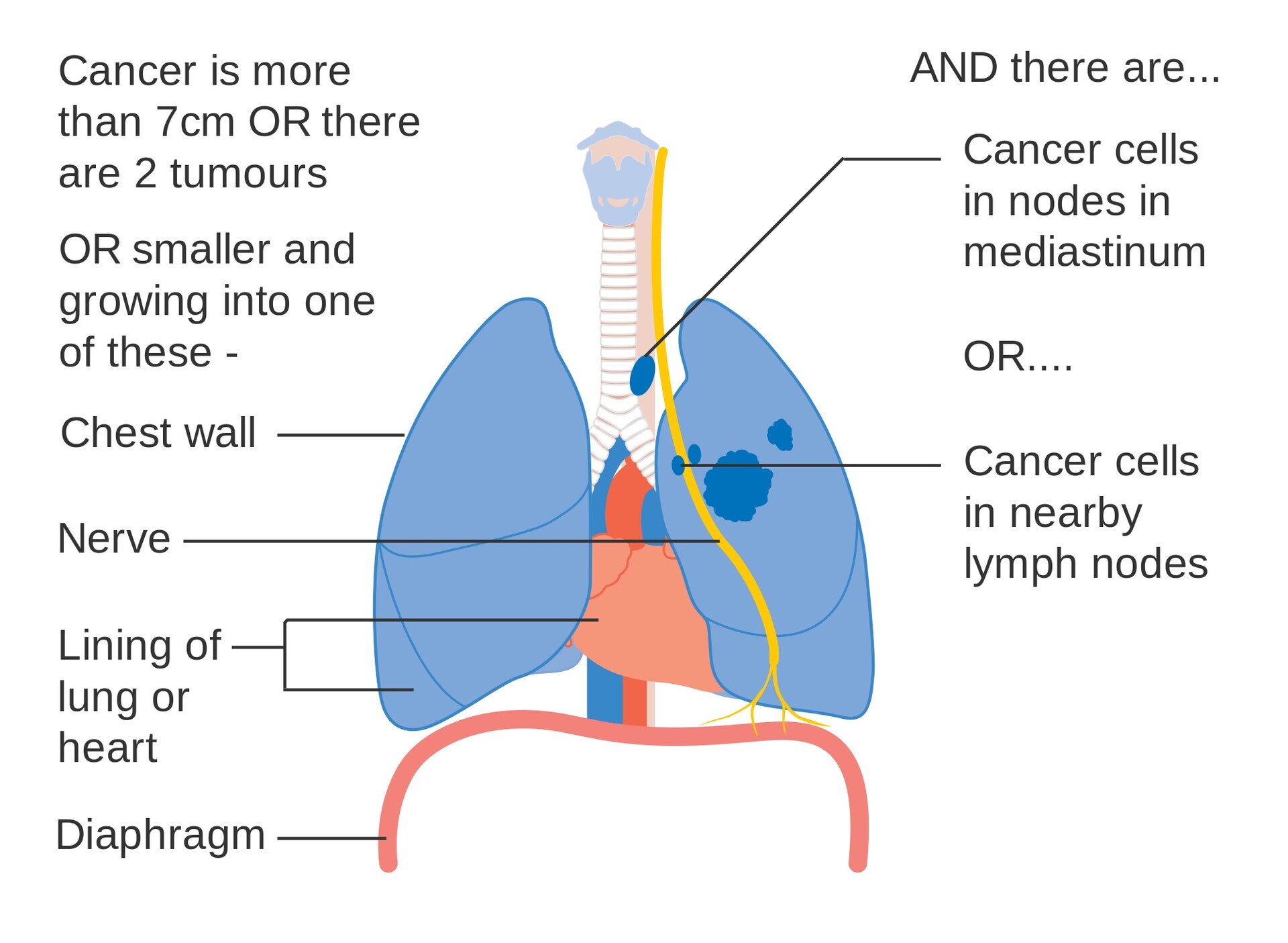Stage 2 Of Lung Cancer
