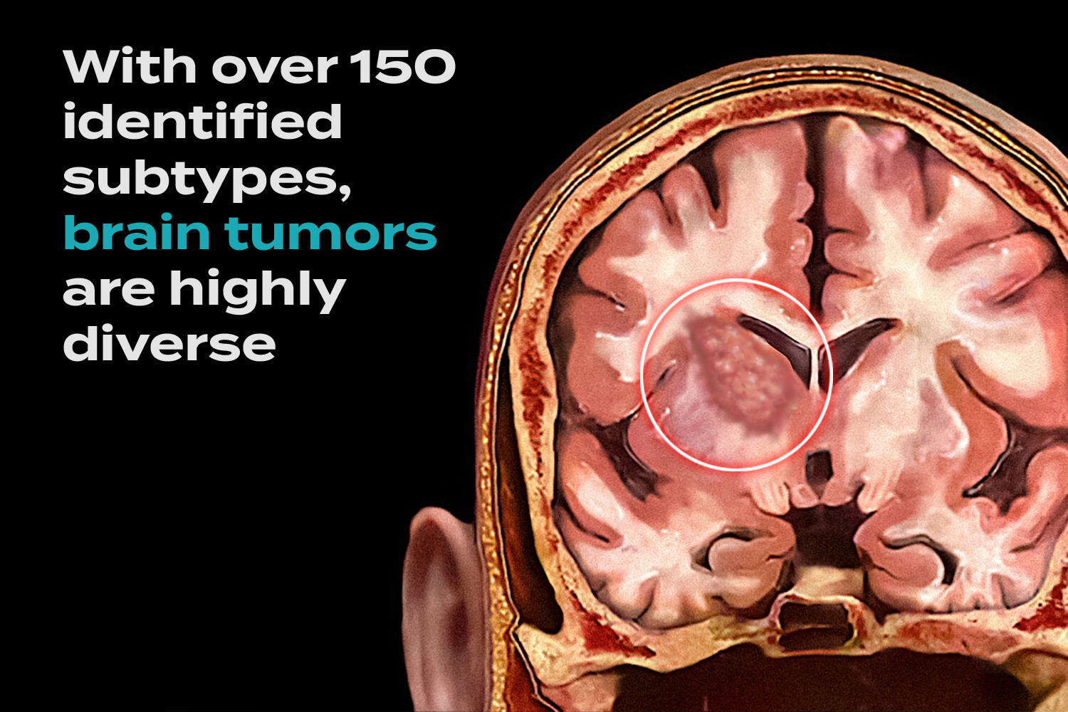 Real Human Brain Tumor Brain Tissue Donation Explained: Answers To