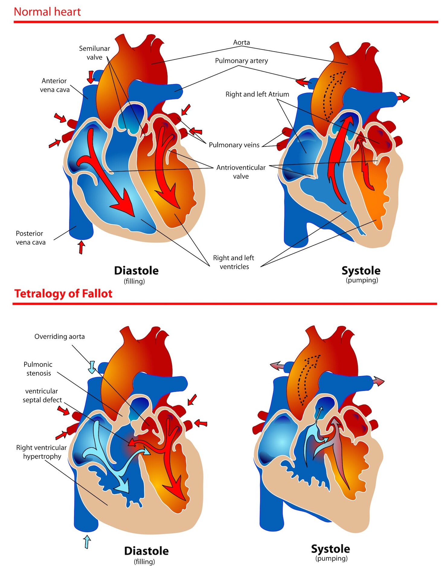 Tetralogy Of Fallot Tetralogy Of Fallot: Key Causes, Diagnosis, And