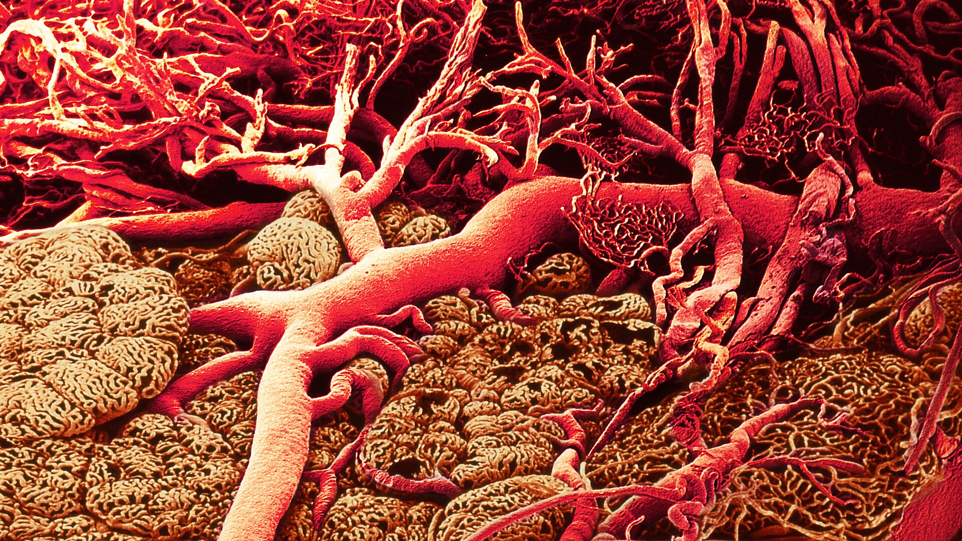 Megalencephaly Causes