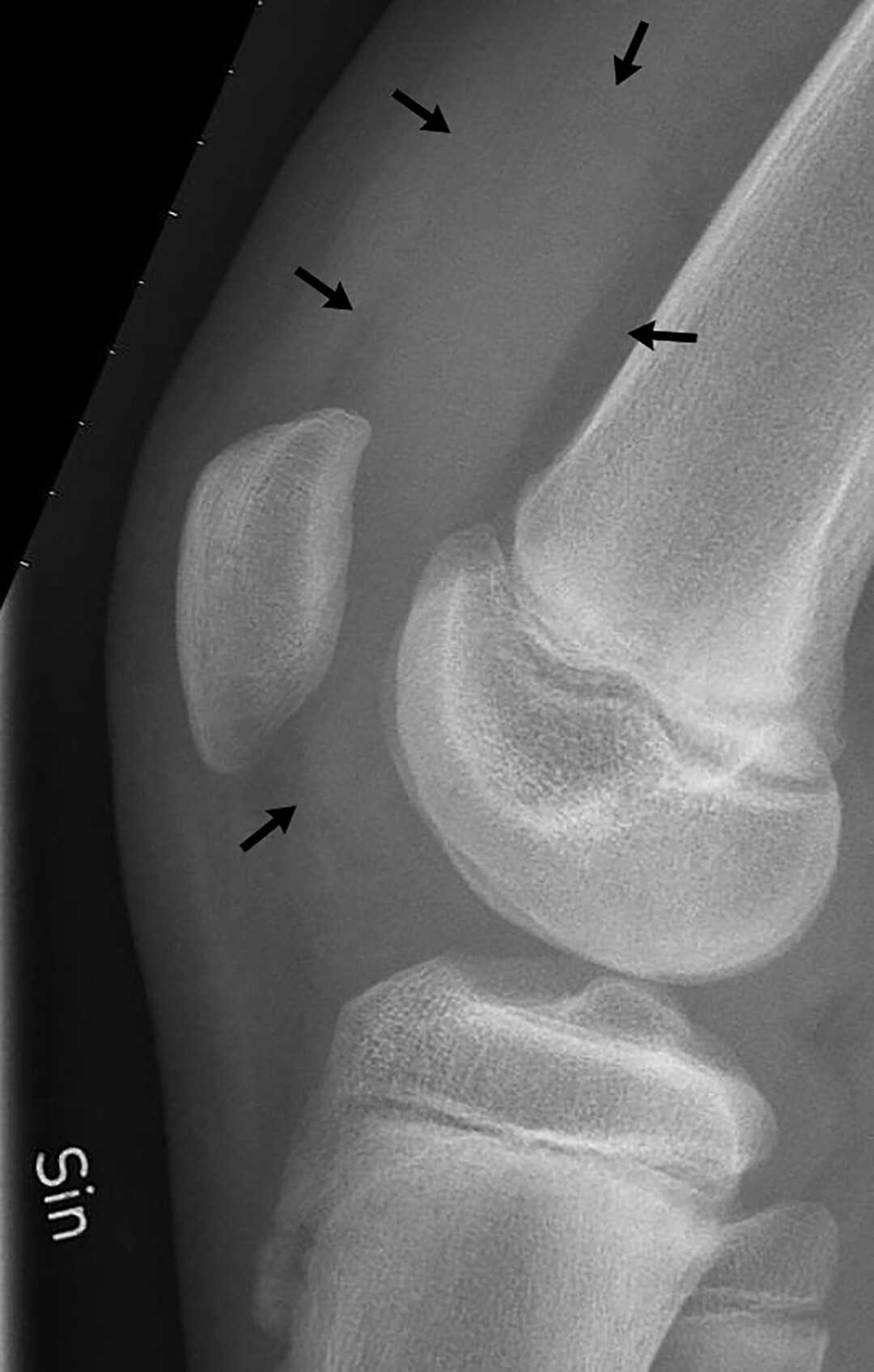 Knee Effusion Diagnosis StoryMD