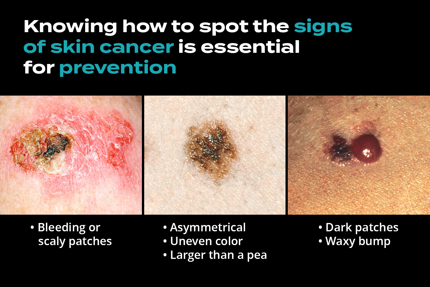 Mole Cancer Signs Are New Moles Always A Sign Of Cancer?