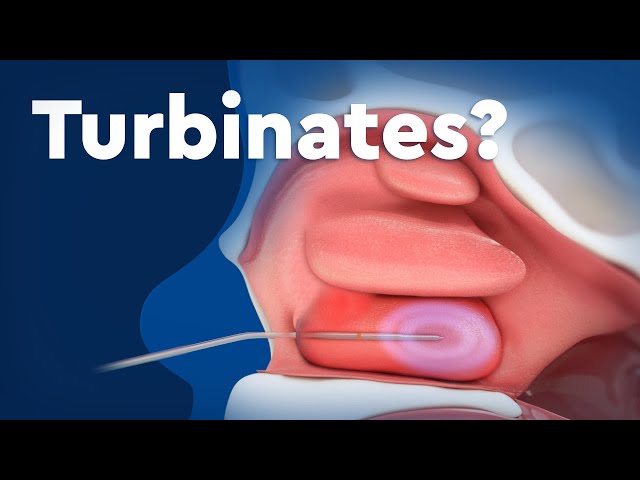 Turbinectomy Adalah Ppt Pediatric Turbinate Hypertrophy Nina L