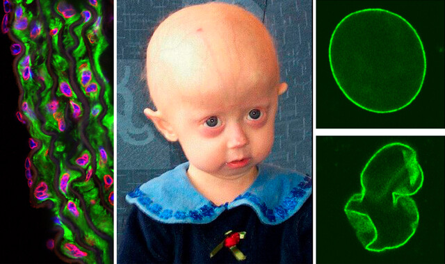 Progeria Causes Symptoms Diagnosis And Treatment