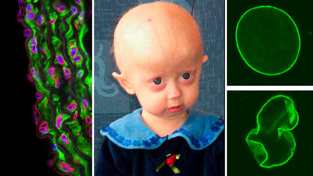 Hutchinson Gilford Progeria Syndrome Hutchinson Gilford Progeria