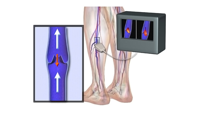 Doppler Ultrasound: Why Is It Done and What the Results Mean
