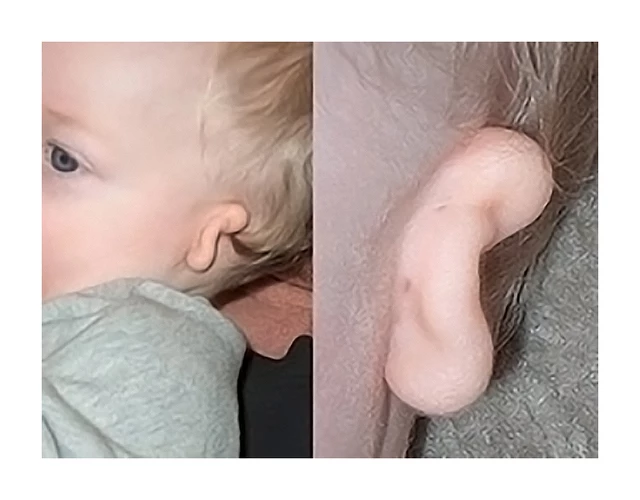 Types Of Ear Deformities In Babies