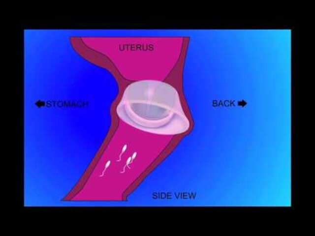Diaphragm Vs Cervical Cap Diaphragm, Cervical Cap, And Vaults Are