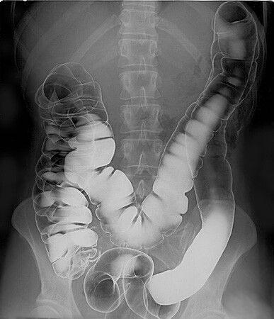 What Is A Upper Gastrointestinal Series