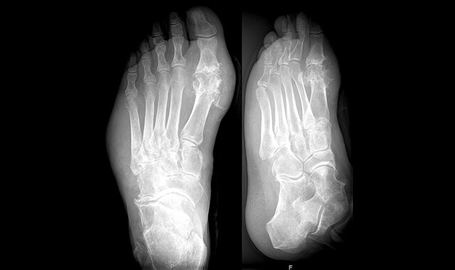 Uric Acid Test: Why Is It Done and What the Results Mean - StoryMD