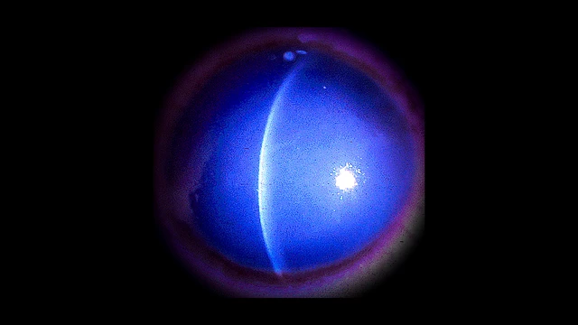 Meesmann Corneal Dystrophy Corneal Dystrophy | Treatment & Management