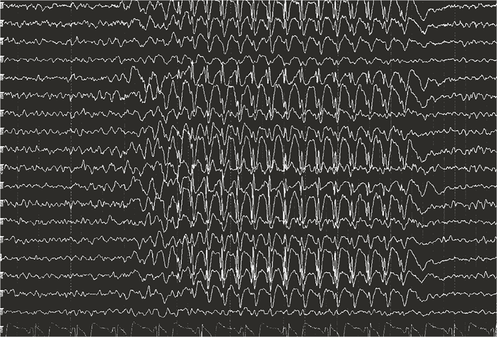 Seizure Eeg Waves