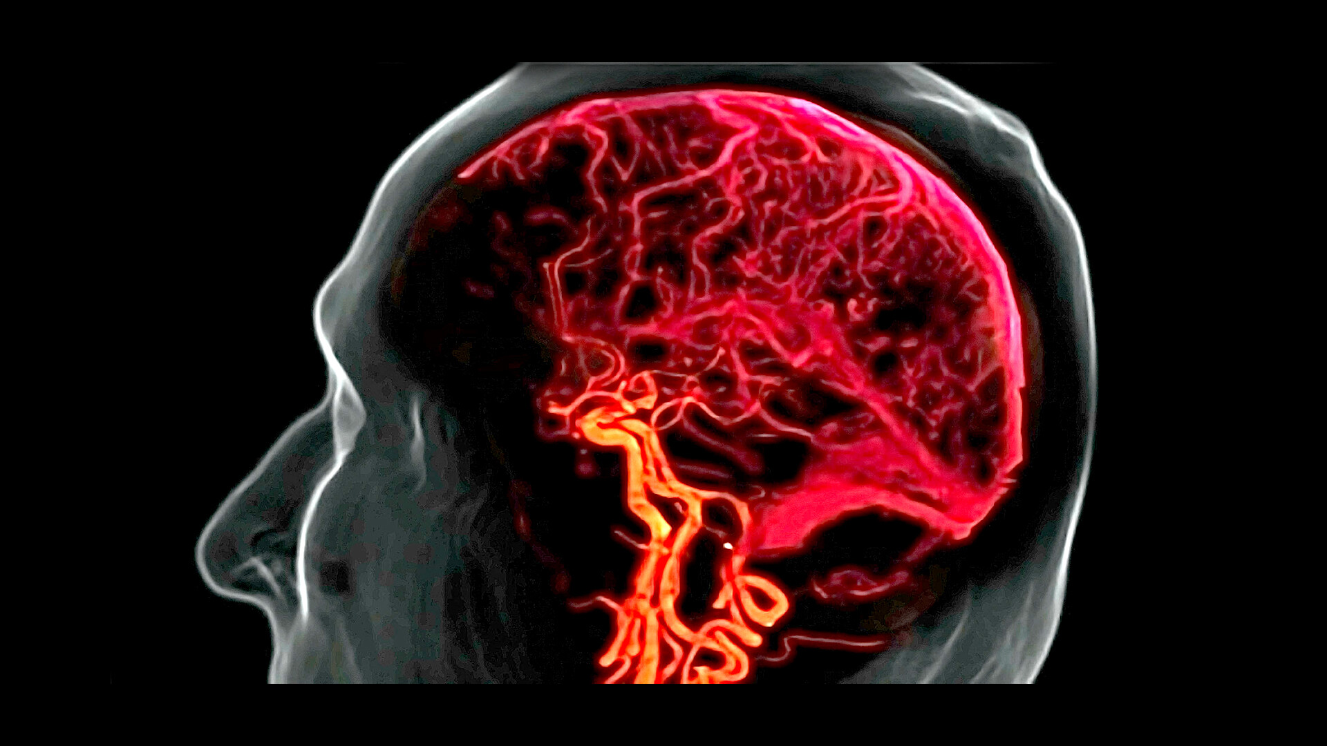Cerebral Cavernous Malformation 🧠 **Understanding Cavernous