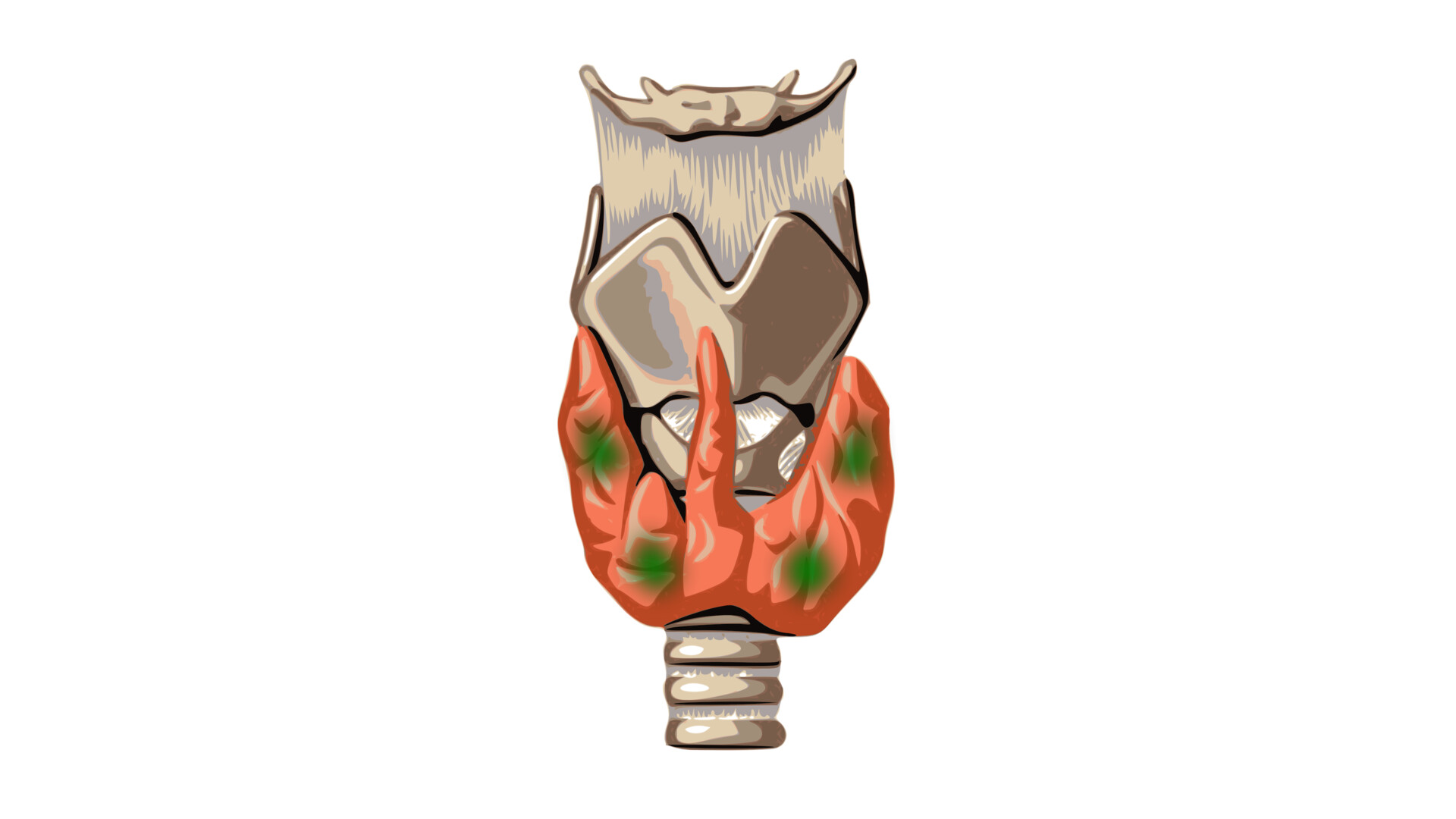 Parathyroid Gland Model