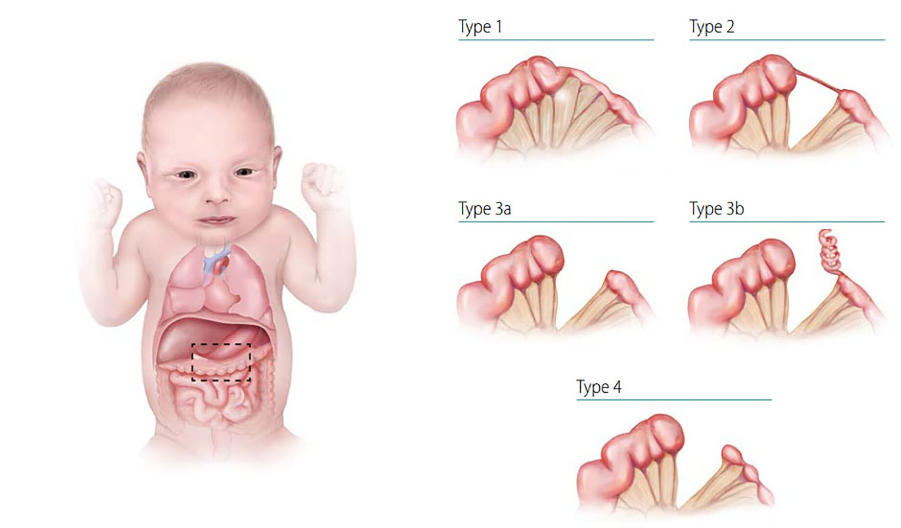 What Is Jejunal Atresia