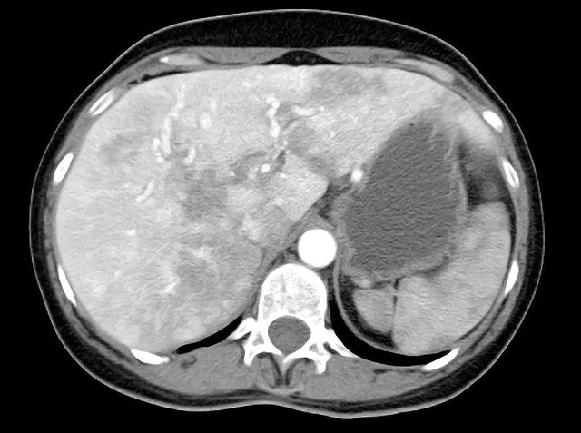 Hereditary Hemorrhagic Telangiectasia Symptoms Causes What Is HHT And