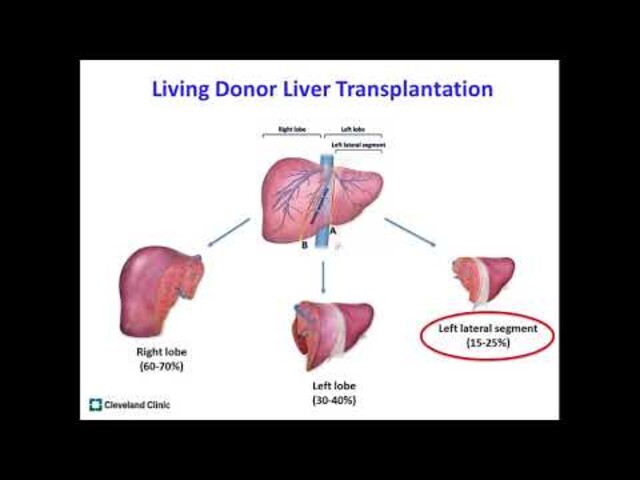 Liver Transplant Diagram Living Donor Liver Transplantation In