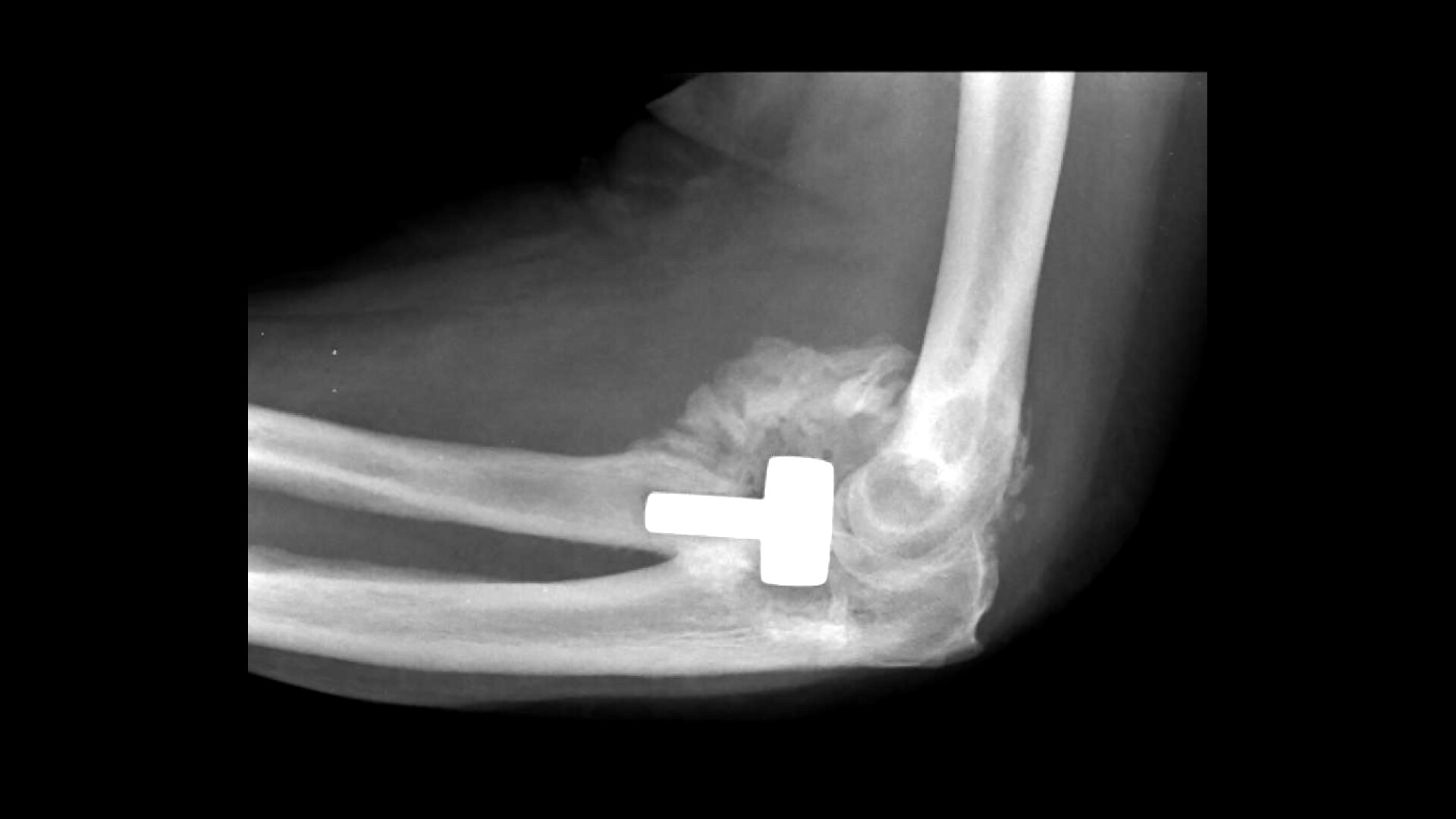 Fibrodysplasie Ossificans Progressiva Röntgenfoto