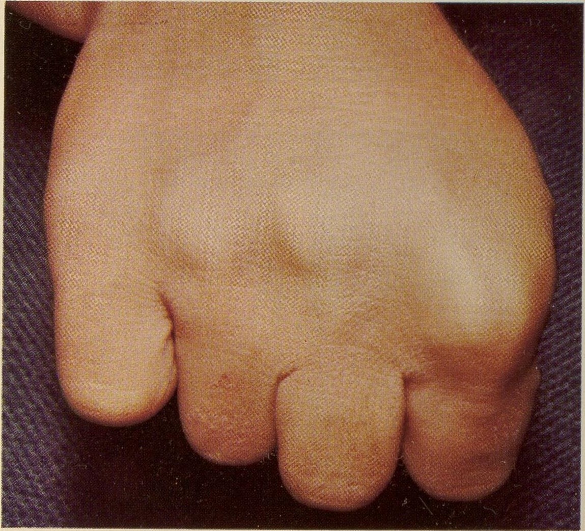 Albright Hereditary Osteodystrophy Aho