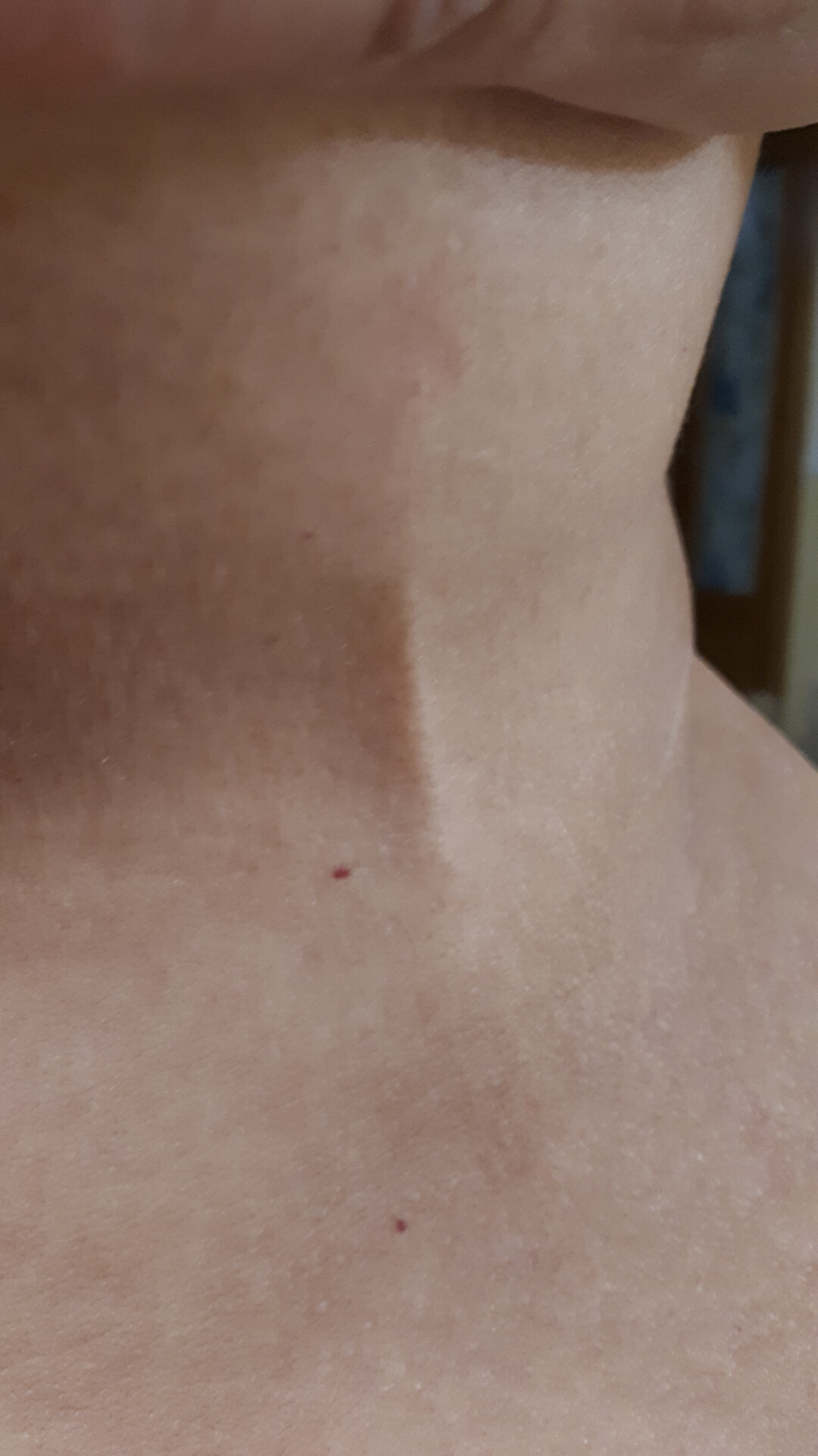 Mondor's Disease Abdomen