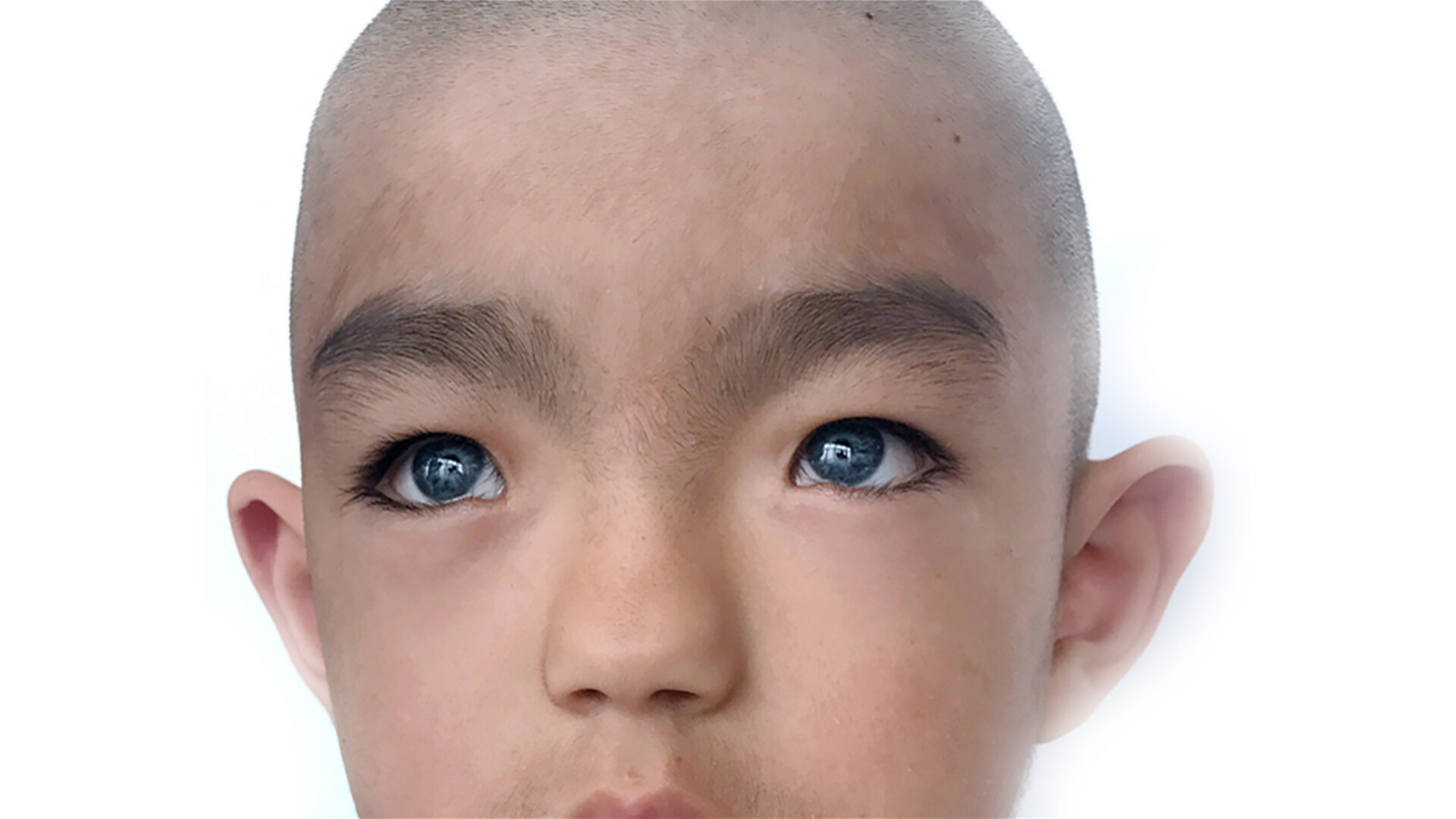 Waardenburg Syndrome Adalah 4772