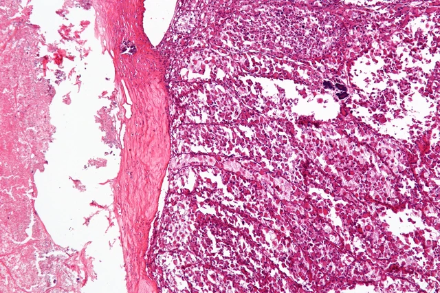 Alveolar Soft Part Sarcoma