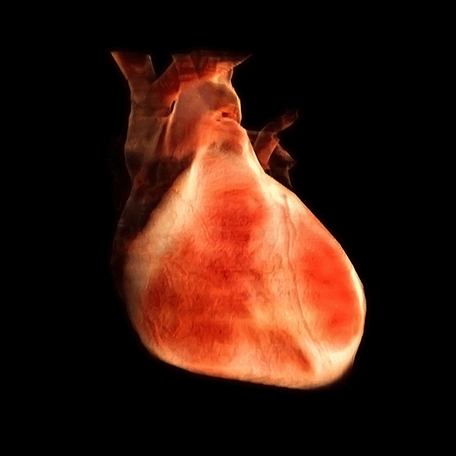 Heart Attack Animation Gif Heart Attack Stock Video 627208702