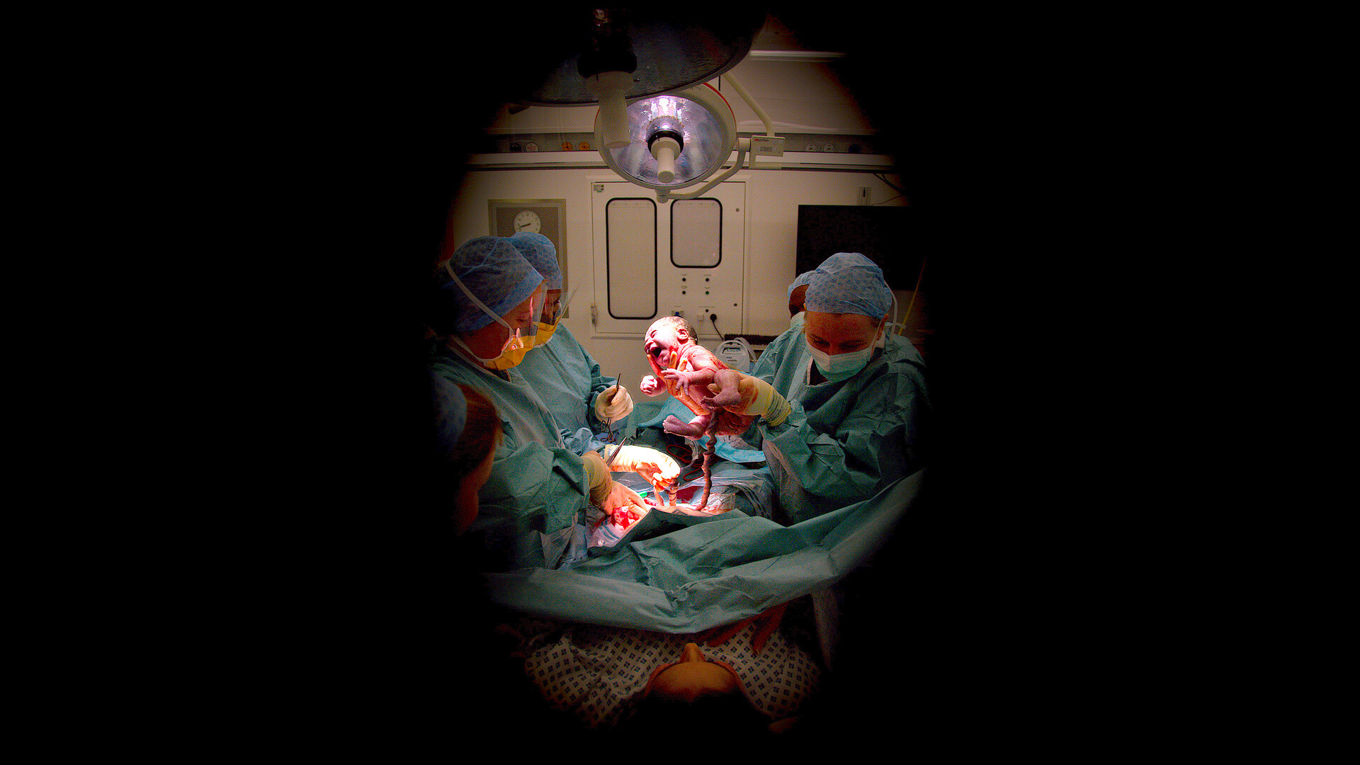 Cesarean