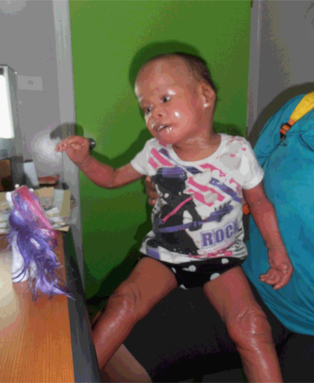 Harlequin Ichthyosis What Is It Causes Signs Symptoms Vrogueco