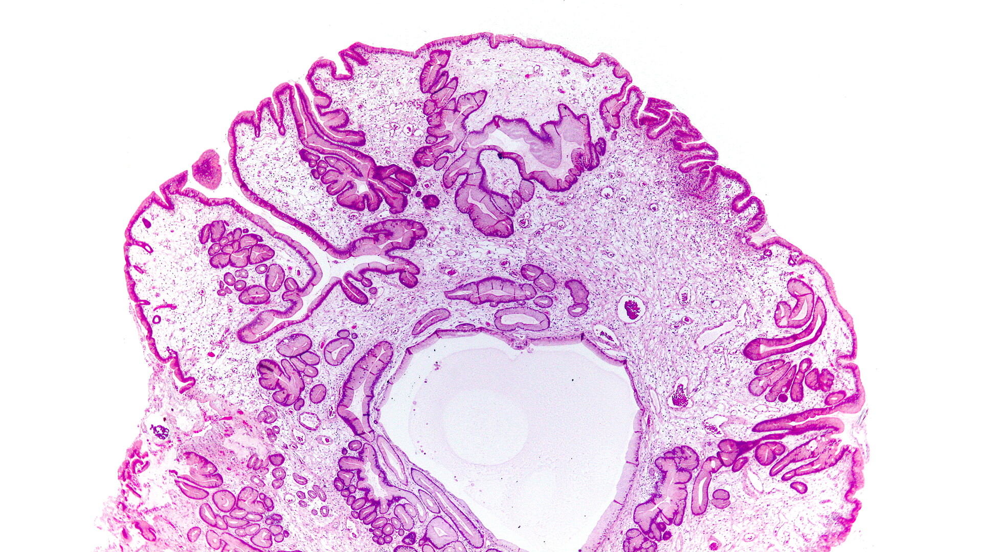 Juvenile Polyposis Syndrome