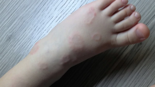 Anulare Granuloma Annulare Possibly Secondary To Oral Treatment With