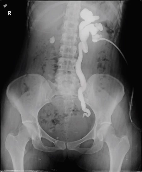 Ureterovesical Junction Obstruction What Is Congenital Anomalies Of