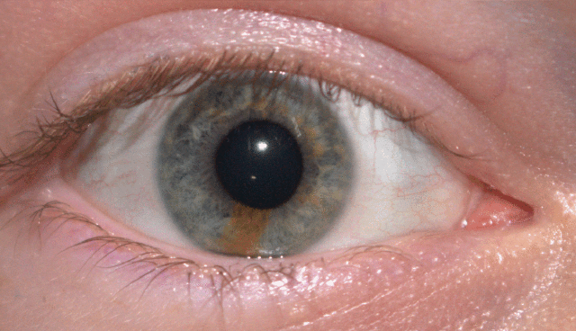 Walleye Eyes Human