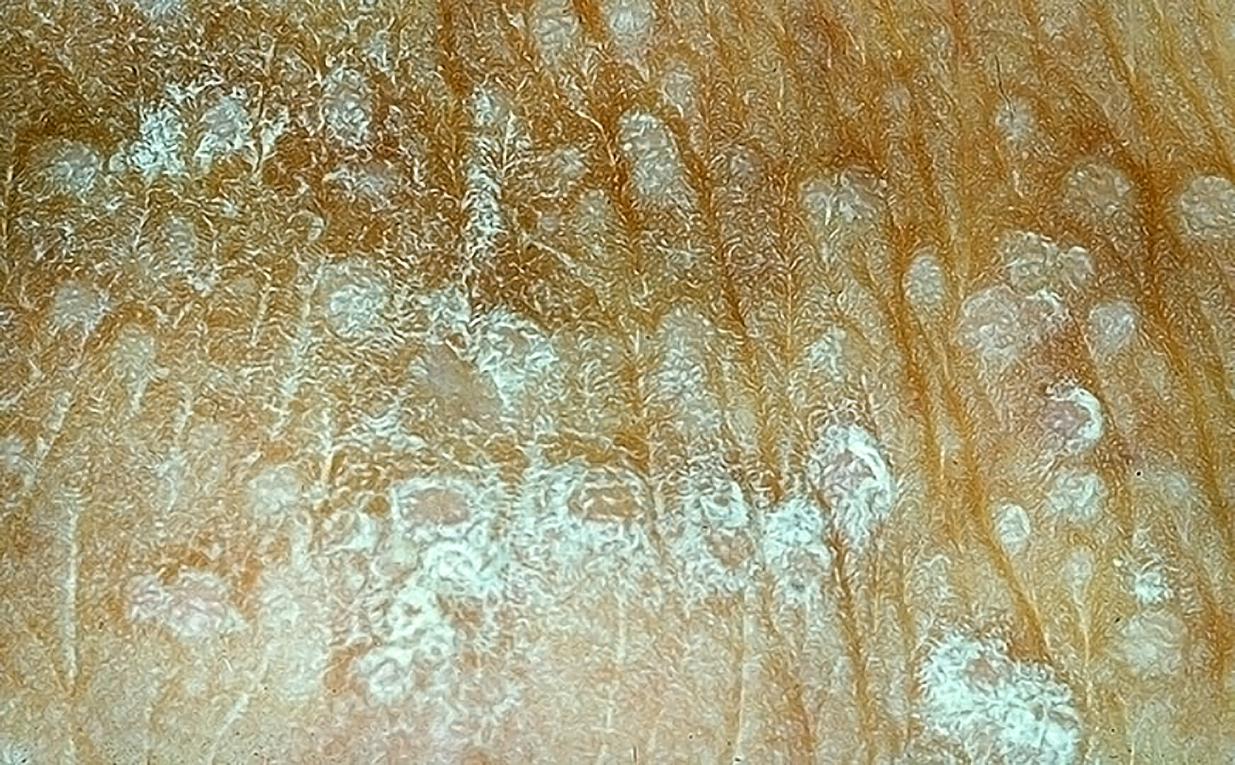 Cowden Syndrome Triad