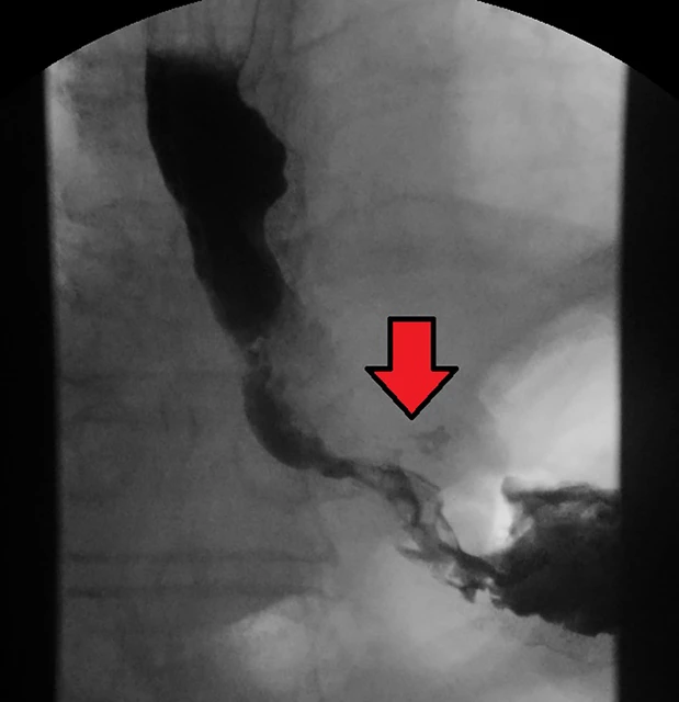Esophageal Cancer Barium Swallow A Clinical/pattern Approach For