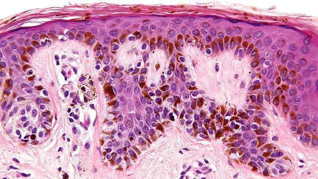 Dysplastic Nevus Histology Dysplastic Nevi Have An Overall Mutational
