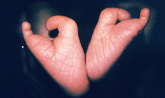 Ectrodactyly Baby 14 THINGS YOU DIDN'T KNOW ABOUT ECTODERMAL