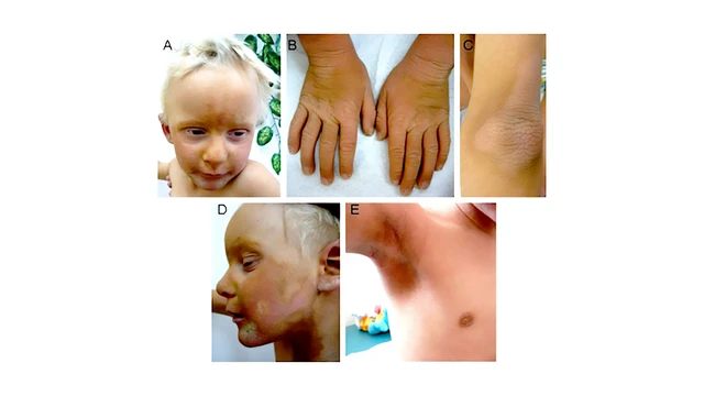 Ectodermal Dysplasia Syndrome Related Healthjournals Ectodermal