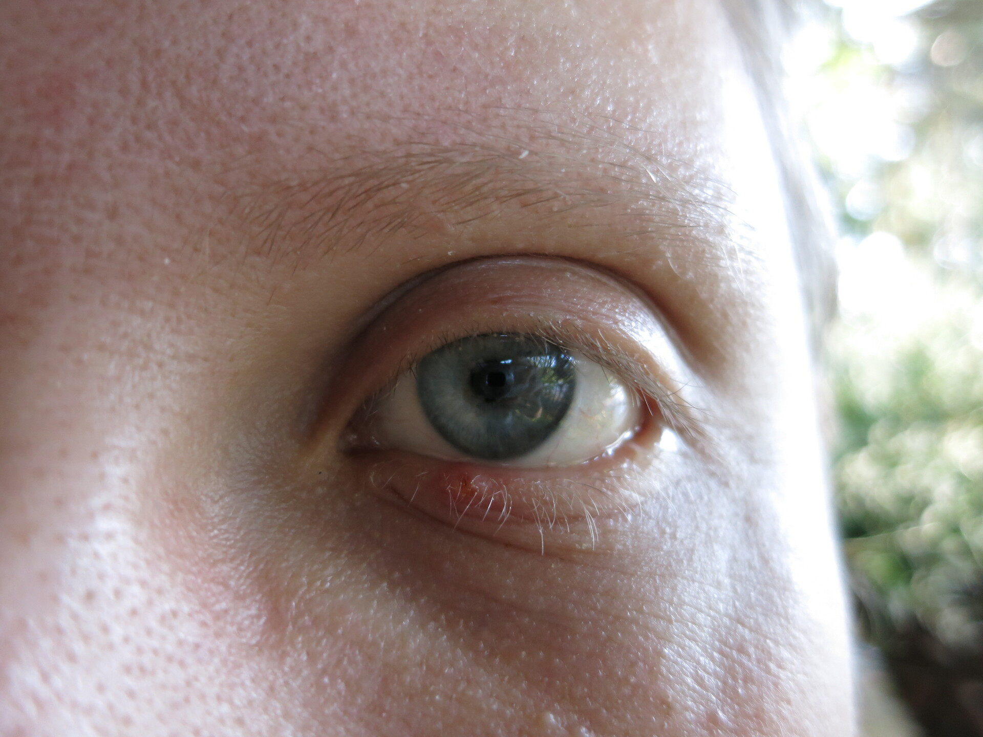 Eyelid Disorders Diagnosis And Management American Rash Around Eyes: