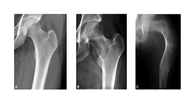 Albright Hereditary Osteodystrophy Symptoms