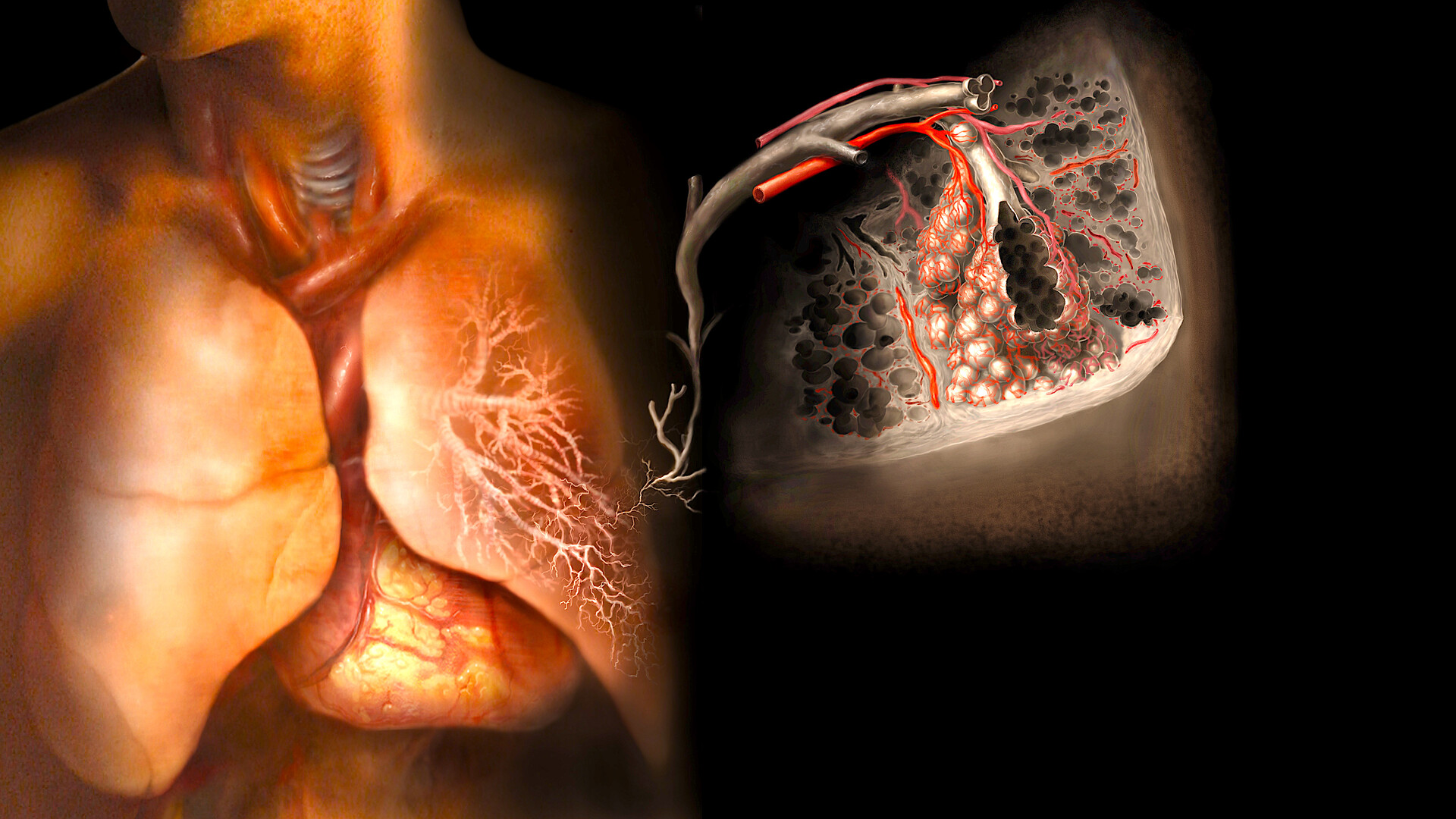 Alpha 1 Antitrypsin Deficiency StoryMD