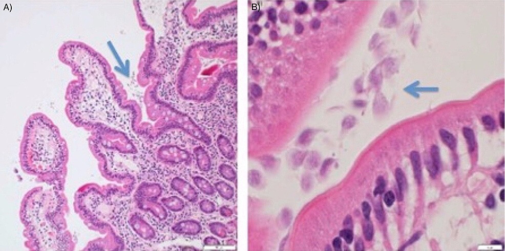 Giardiasis Beaver Fever Symptoms Causes Diagnosis Giardiasis
